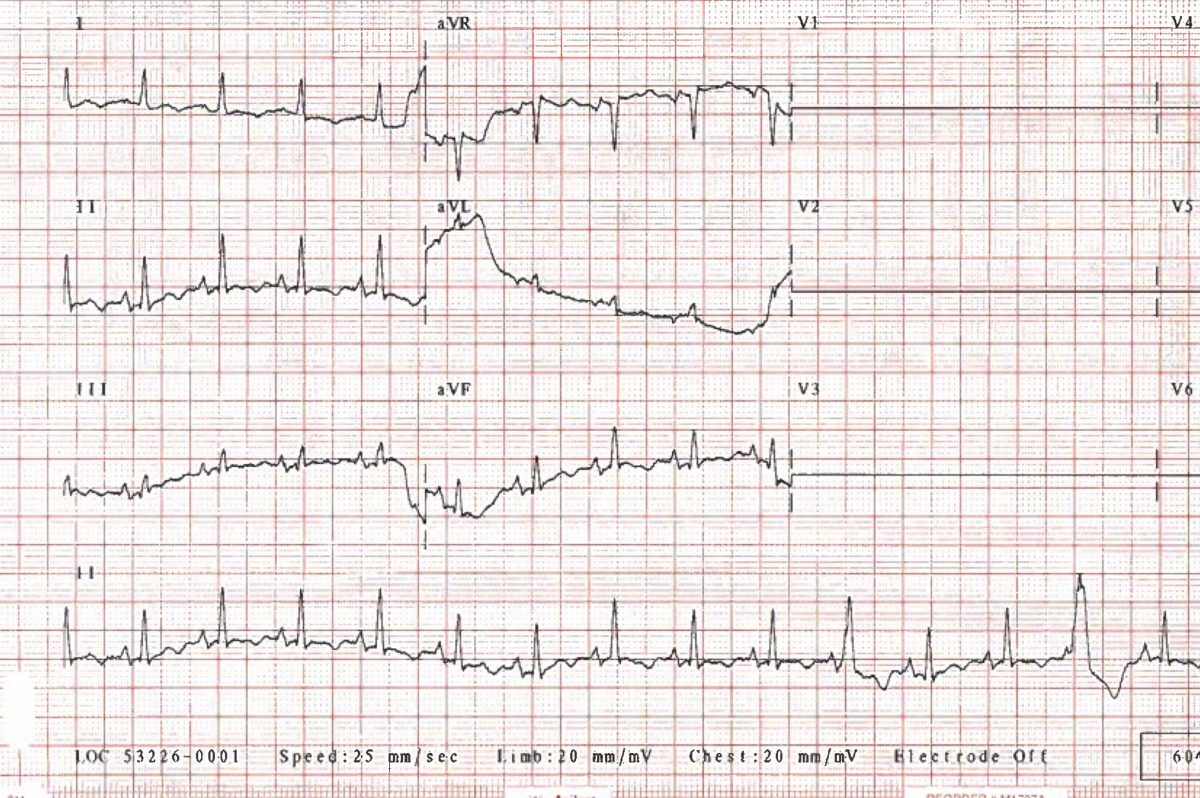 Electrocardiograms (ECGs/EKGs)